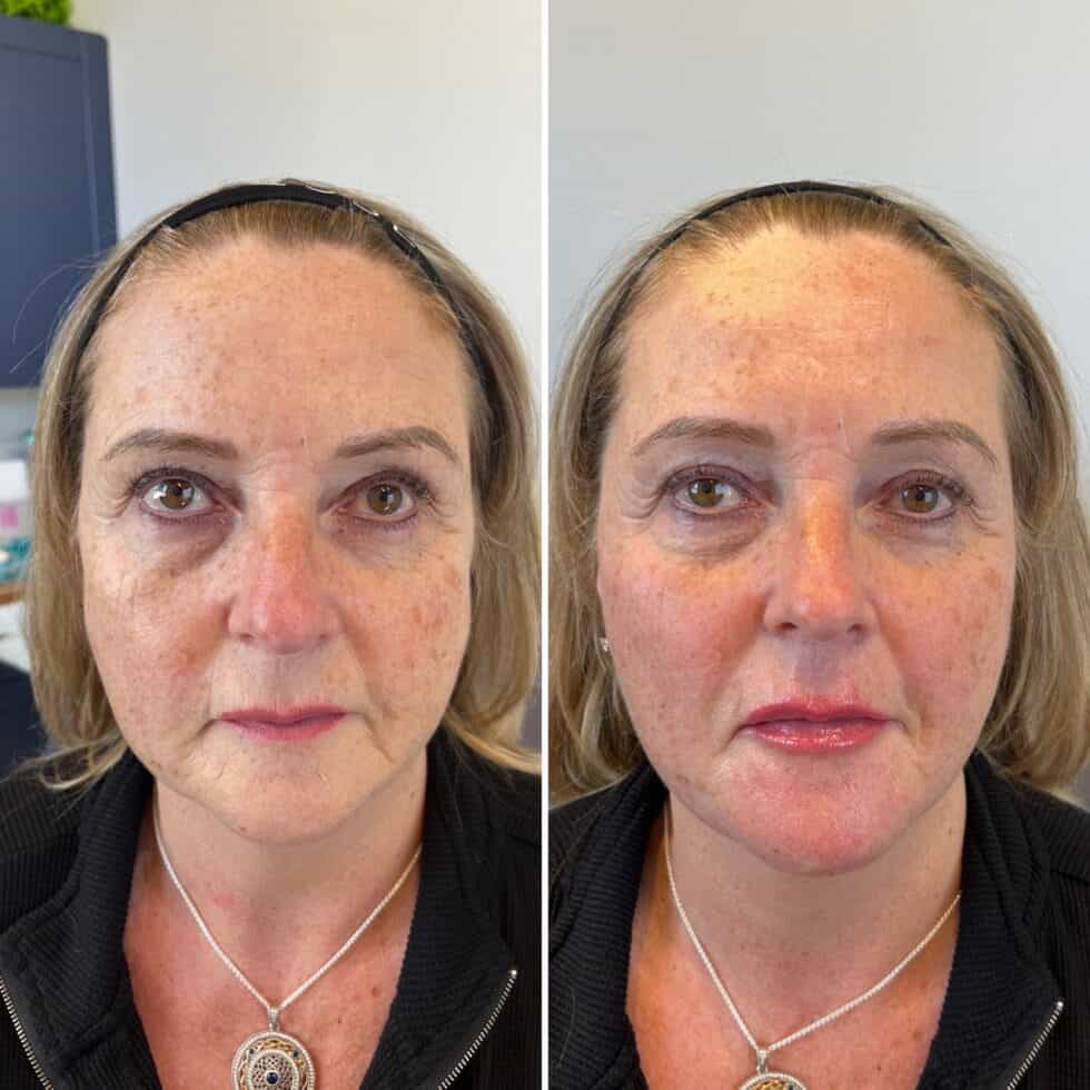 Full Face Rejuvenation with Fillers: What’s the hype? | Dr Heather Iverson