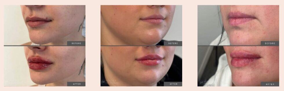 Lip Filler: Should I get a half or full syringe? | Dr Heather Iverson