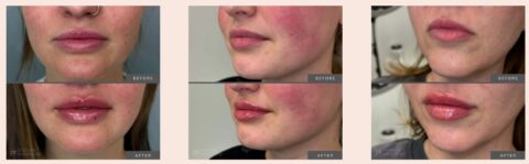 Lip Filler: Should I get a half or full syringe? | Dr Heather Iverson